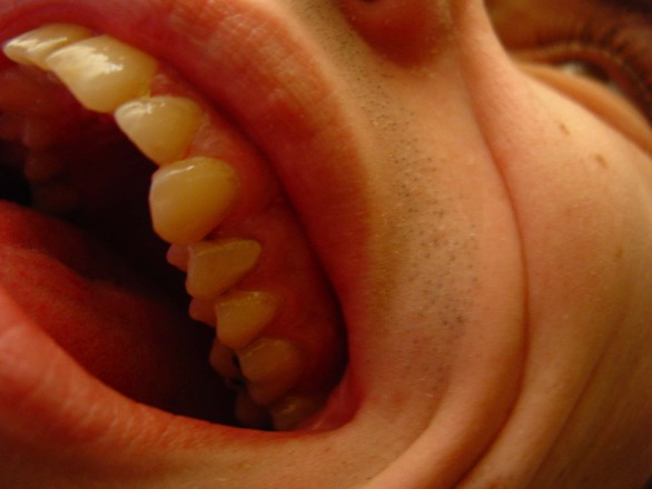 Fogínygyulladás gyógyszer tippek és a kezelés fogorvos segítségével ...